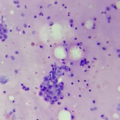 Cryptococcus Meningitis Smears Showing Capsulated Cryptococcus Download Scientific Diagram