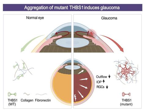 Pesquisa Identifica Nova Mutação Genética Por Trás Do Glaucoma Infantil Phelcom Technologies