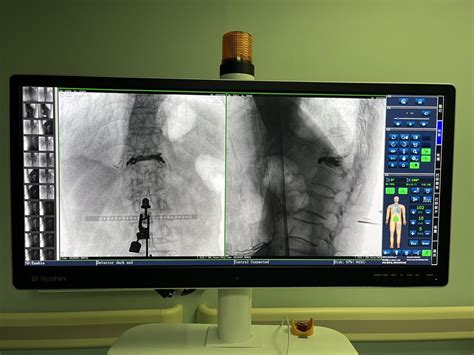 How Can Orthopedic Surgical Robots Reduce Surgical Risks Perlove