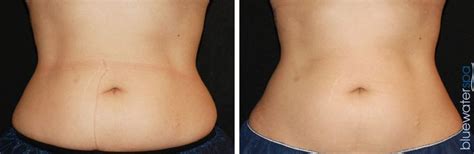 Coolsculpting® Lower Abdomen Photo Gallery