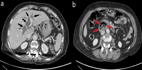 A Dilated Intrahepatic Bile Ducts Observed On Abdominal Ct Black Download Scientific Diagram