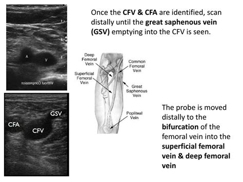 Ppt The Evaluation Of Dvt Bedside Ultrasound Diagnosis And Evaluation