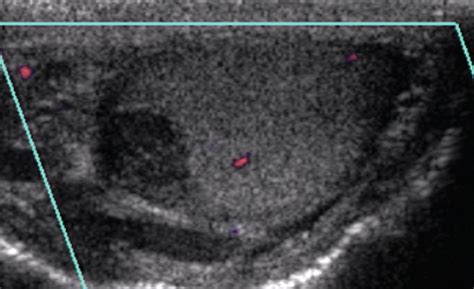 What Is An Avascular Nodule At Kenneth Locke Blog