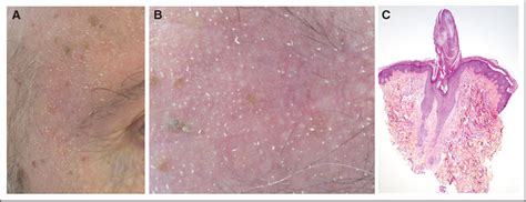 Follicular Hyperkeratosis