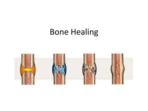 Bone Healing Ppt