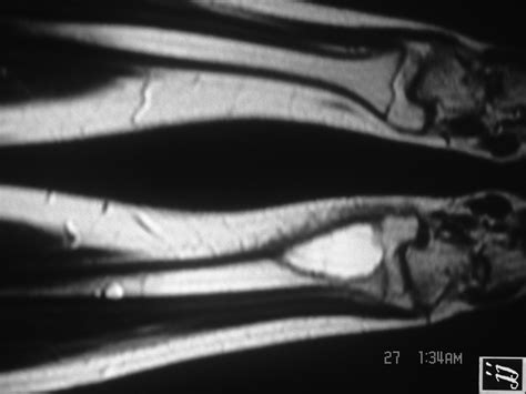 Distal Tibial Cyst Radiopaedia