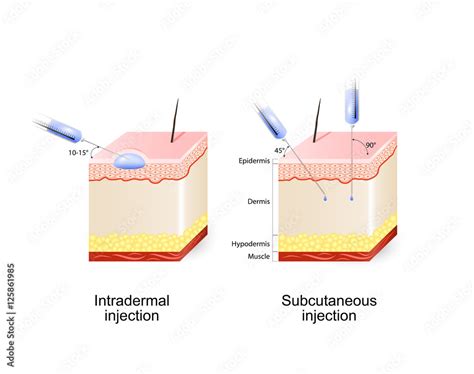Intradermal And Subcutaneous Injection Angle And Depth Of Injections