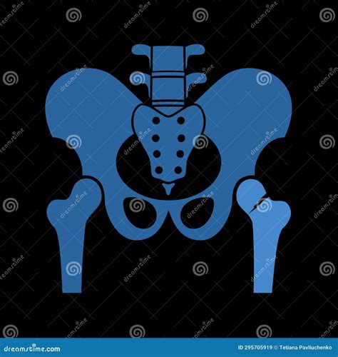 Hip Bone Fracture Stock Illustration Illustration Of Osteoporosis 295705919