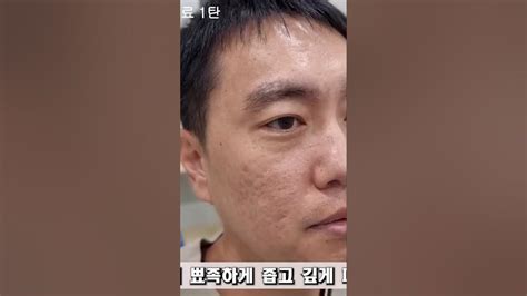여드름 흉터의 종류kbeauty Acnescars 여드름흉터 Youtube