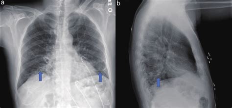Posteroanterior A And Lateral B Chest X Ray Demonstrating Patchy Posteroanterior A And Lateral B Chest X Ray Demonstrating Patchy