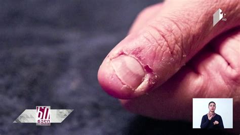 მავნე ჩვევები რა კავშირშია დერმატოფაგია შფოთვითი აშლილობის სინდრომთან Youtube