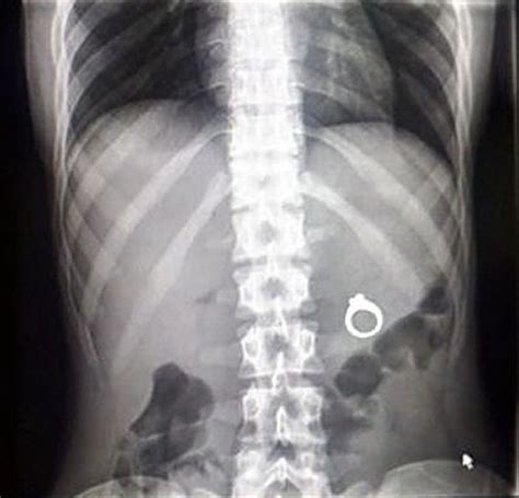 10 Foto Yang Pernah Tertangkap X Ray Dari Tubuh Manusia Bikin Merinding