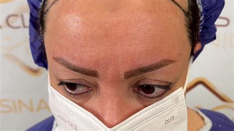 کاشت موی سر خانم ها نماشا