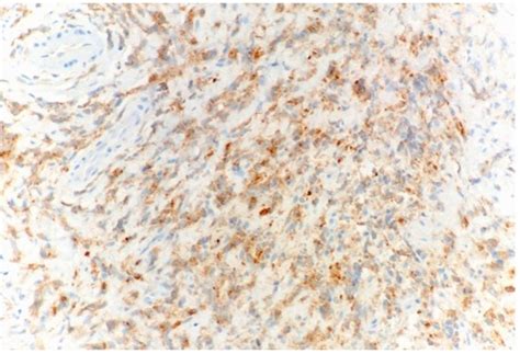 Ics 2024 Abstract 361 Voiding Dysfunction Secondary To A Primary Uterine Cervix Lymphoma