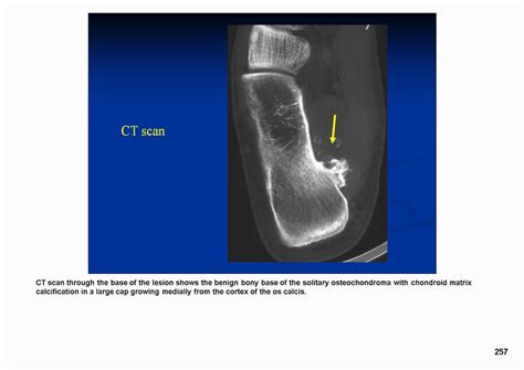 Secondary Peripheral Chondrosarcoma An Atlas Of Musculoskeletal Oncology