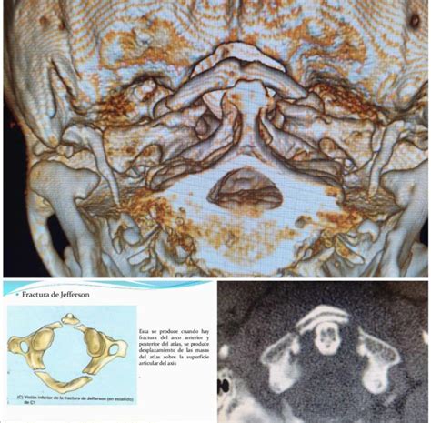 C1 Fracture R Spinesurgery