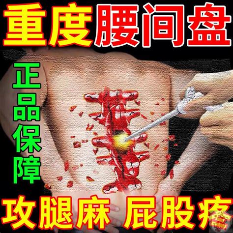 腰椎間盤突出【3天全俞】腰椎疼痛坐骨神經痛屁股疼腿麻特效腰椎間盤突出【3天全舒】腰痛壓縮坐骨神經痛腿麻木效果 蝦皮購物