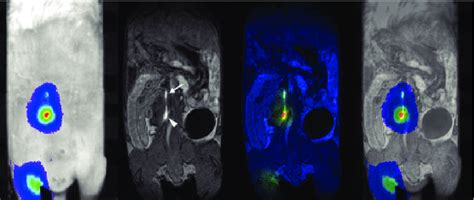 Integrated Flimri Showing The Lumbar Aortic Lymph Node Arrow In
