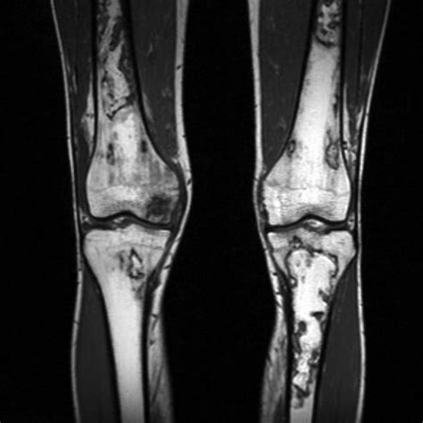 Acute Bone Infarct Due To Sickle Cell Anemia Pacs