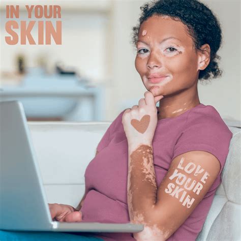 Segmental Vs Non Segmental Vitiligo R Vitiligo