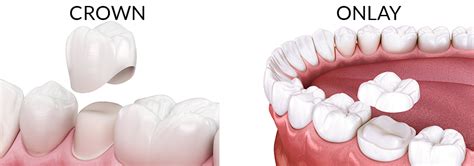 Know The Difference Between A Dental Crown And An Onlay Ocnif