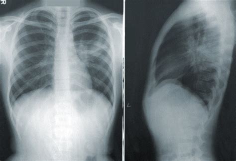 Detecting Pneumonia From Chest X Rays With Deep Learning By Shaya Farahmand Towards Data Science