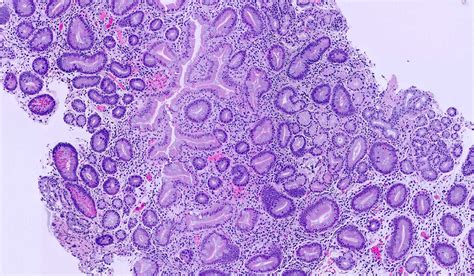 Pathology Outlines Chronic Gastritis