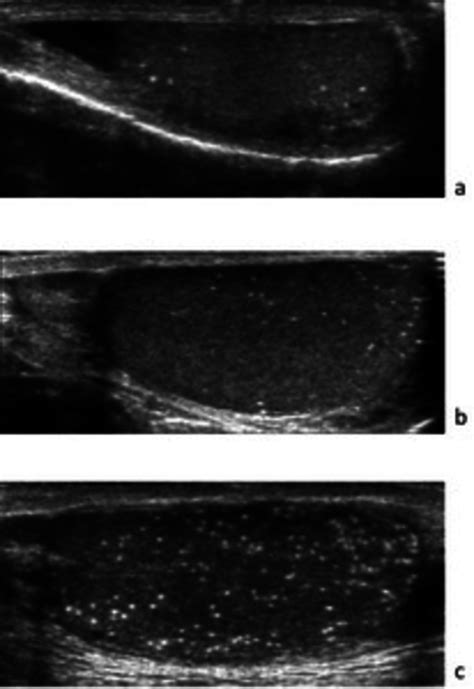 Testicular Microlithiasis A Grade 1 B Grade 2 C Grade 3 References Download Scientific
