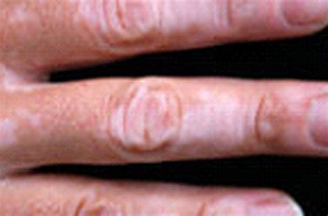 Vitiligo Hypopigmentation