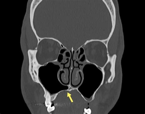 Pneumatization Of The Maxillary Sinus Into The Floor Of The Nose Reaching The Midline