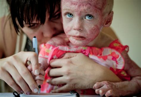 Cornel Van Heerden Burn Survivor Pippie Kruger Discharged