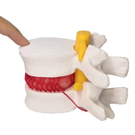 Human Herniated Disc Model Anatomical Herniated Lumbar Vertebrae Disc Prolapse