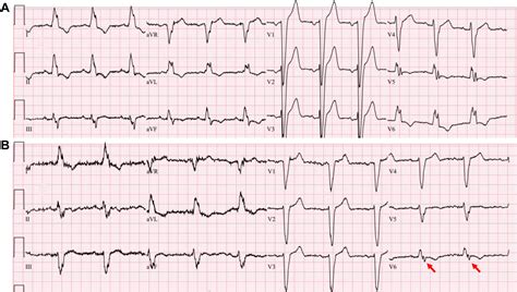first and second degree left bundle branch block and masquerading bundle branch block lessons