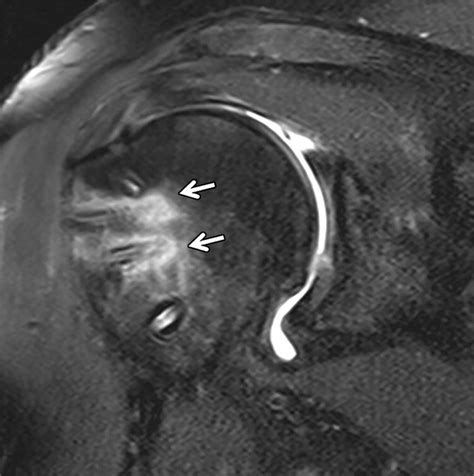 Rotator Cuff Surgery Mri At Molly Carmichael Blog