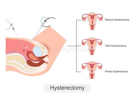 Hysterectomy Is The Surgical Removal Of The Uterus Stock Vector