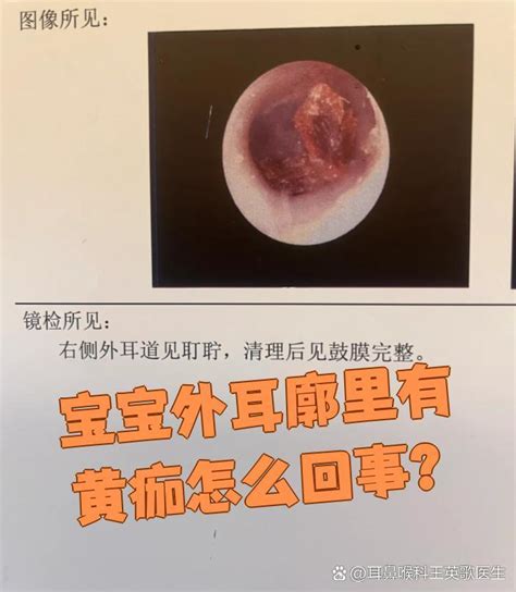 宝宝外耳廓里有黄痂怎么回事？