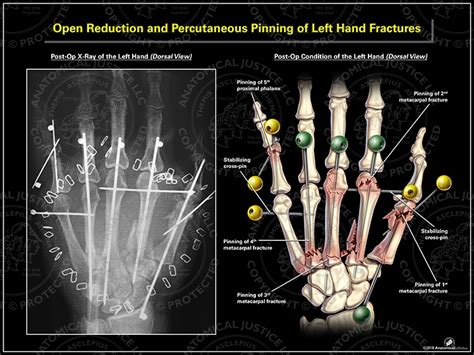 Open Reduction And Percutaneous Pinning Of Left Hand Fractures