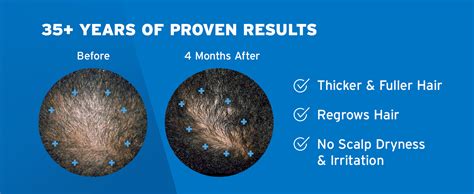 Mens Rogaine 5 Minoxidil Foam For Hair Regrowth Topical