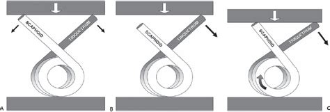 33 Open Resection Of The Distal Pole Of The Scaphoid Musculoskeletal Key