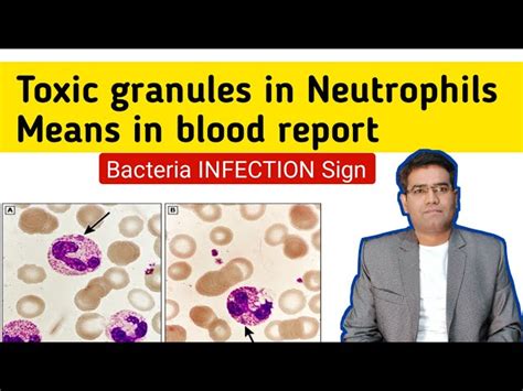 Segmented Neutrophil With Toxic Granulation