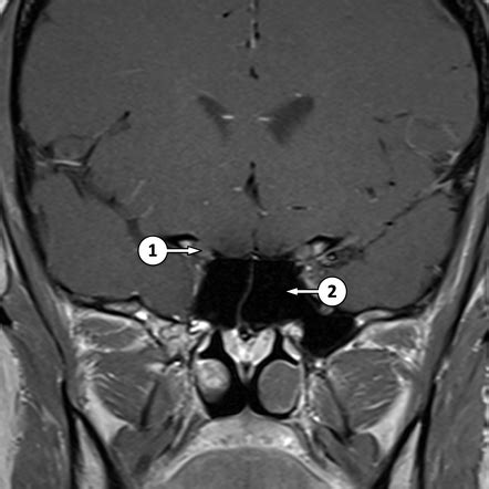 Pituitary Gland Mri