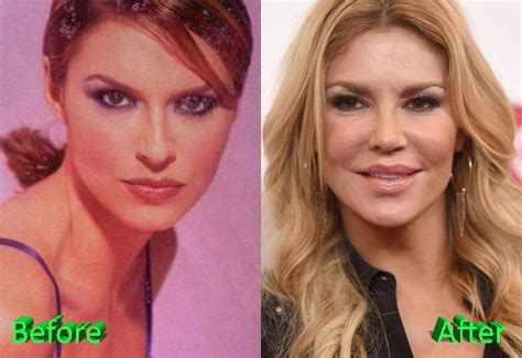 Brandi Glanville Plastic Surgery A Botox Overdose