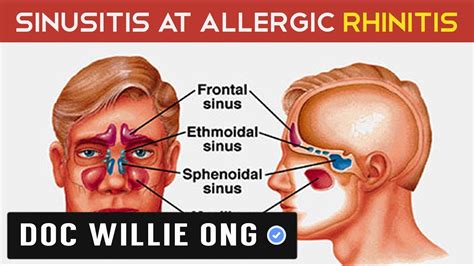 Allergic Rhinitis At Sinusitis Ni Doc Gim Dimaguila 14b Ear Nose