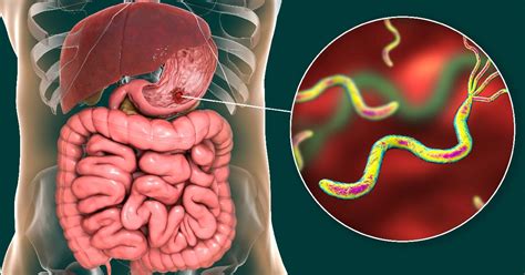 Sta Es La Bacteria Que Podr A Estar En Tus Alimentos Y Aumenta El Riesgo De C Ncer De Est Mago