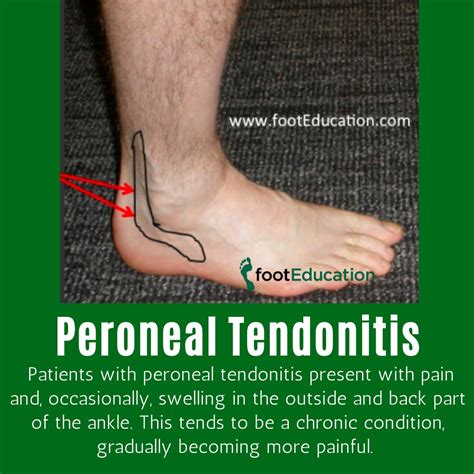 Peroneal Tendinopathy Tendinitis Causes Treatment 59 Off