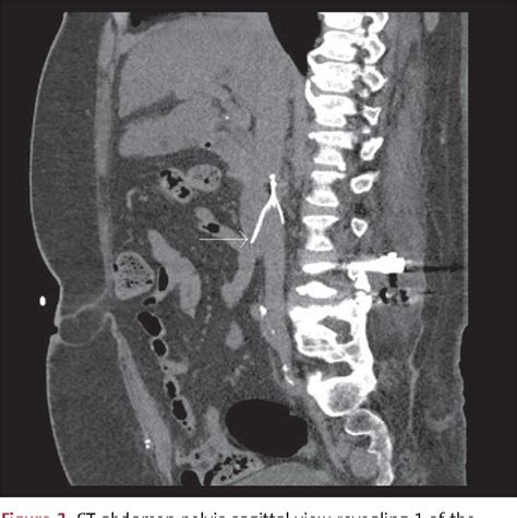 Figure 1 From Ivc Filter Perforation Through The Duodenum Found After