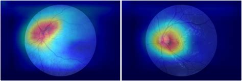 Multi Label Classification Of Retinal Disease Via A Novel Vision Transformer Model Pmc