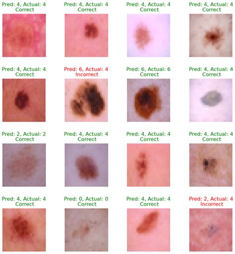 Efficient Harris Hawk Optimization Hho Based Framework For Accurate Skin Cancer Prediction