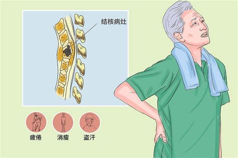 骨头里有空洞，要考虑骨结核吗？ 知乎