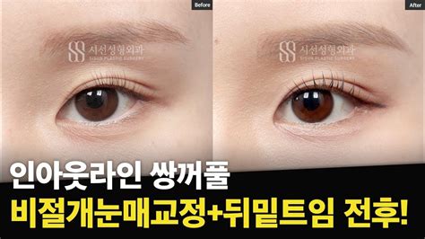 [인아웃라인 쌍꺼풀] 비절개눈매교정 뒤밑트임 전후 Youtube